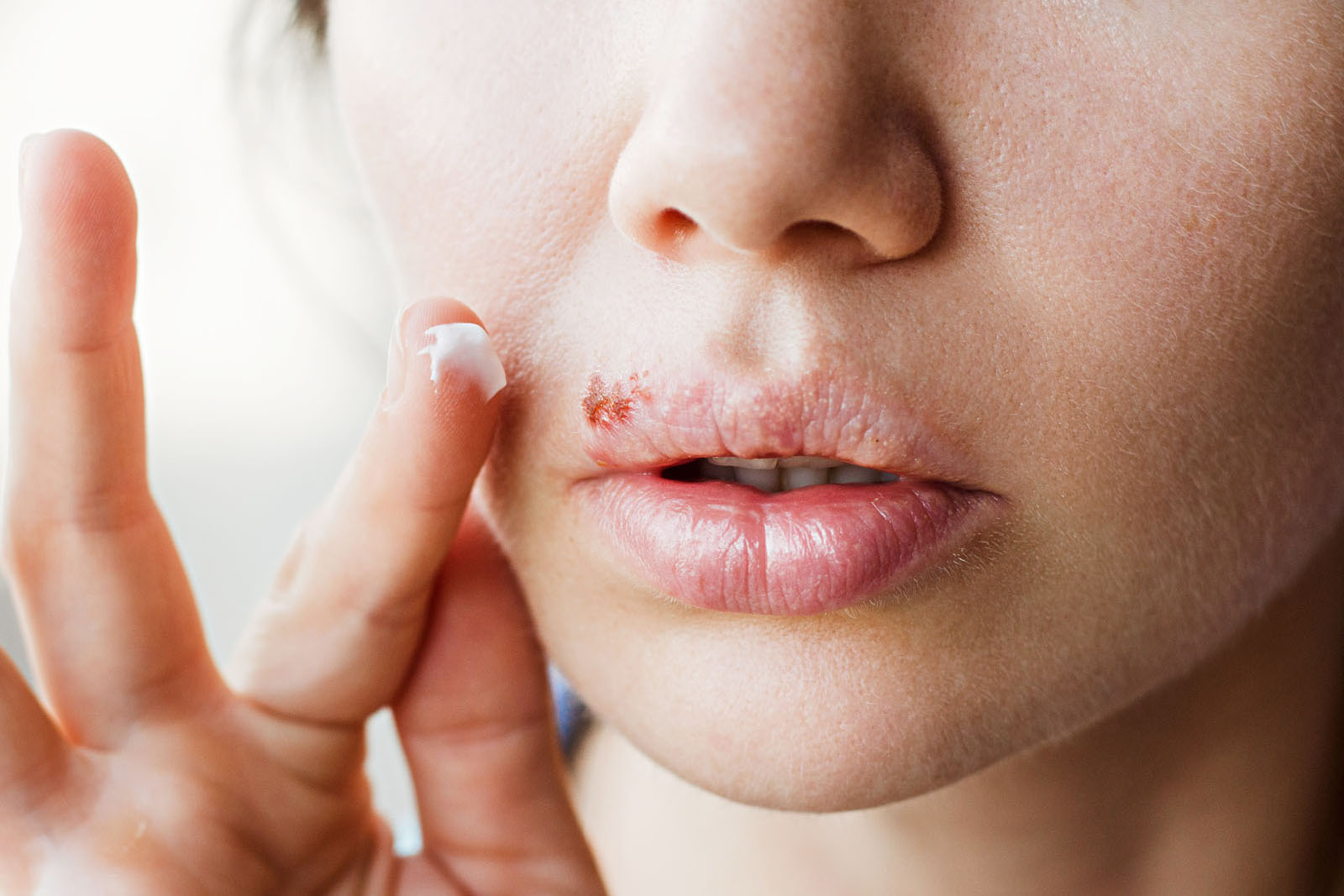 Aj vás sa zmocní nervozita pri slove opar? Liečiť sa dá aj prírodnou ...